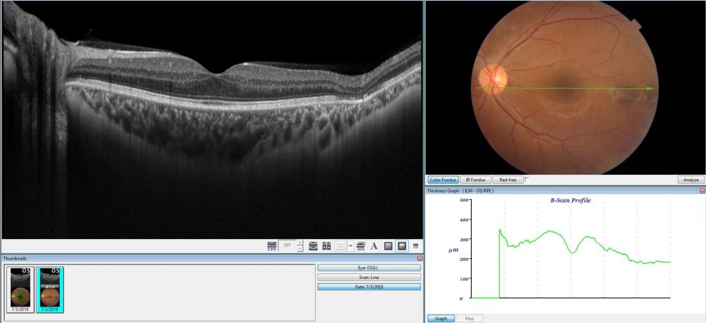 Ocular Tuberculosis Diagnosis and Treatment Approaches