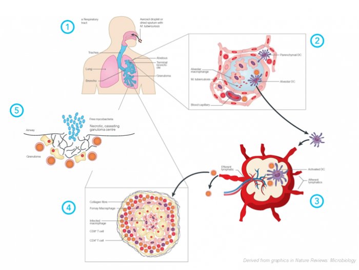 Ocular Tuberculosis: Diagnosis & Treatment