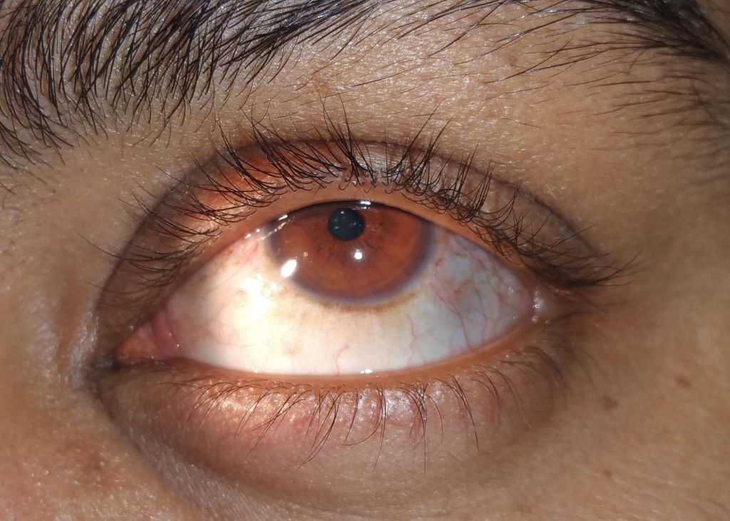 Ocular Tuberculosis Diagnosis and Treatment Approaches
