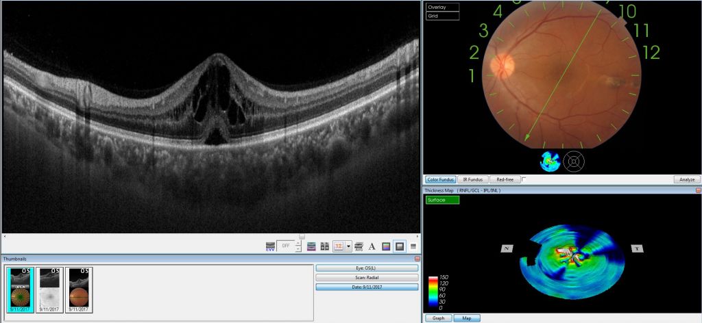 Ocular Tuberculosis Diagnosis and Treatment Approaches