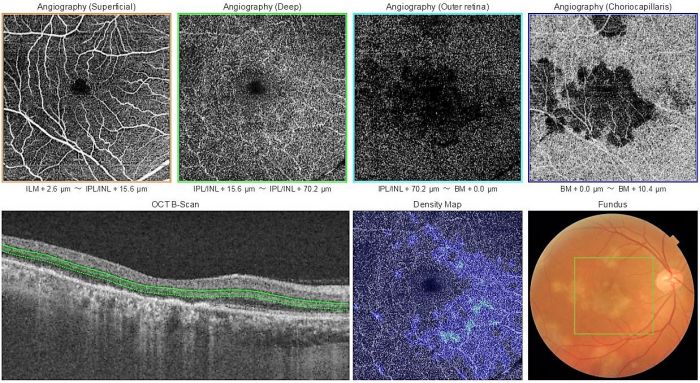 Ocular Tuberculosis Part 4 - Diagnosis & Treatment - Neoretina Blog