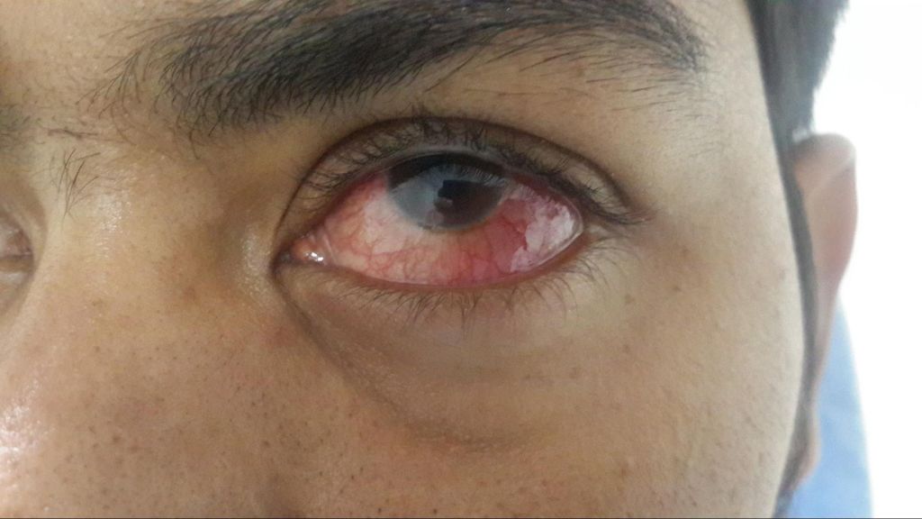 Ocular Tuberculosis Diagnosis and Treatment Approaches