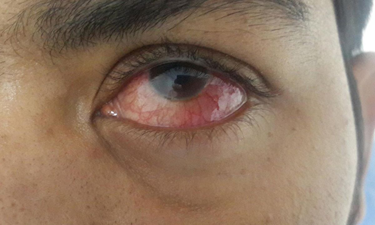 Ocular Tuberculosis To Commemorate The Discovery Of Mycobacterium