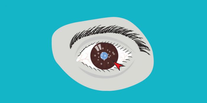 Ocular Tuberculosis: Diagnosis & Treatment