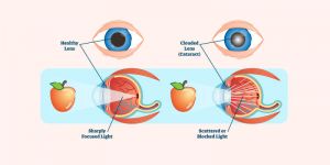 Understanding Working Lenses, Cataract Types, Diagnosis, and Eye Care