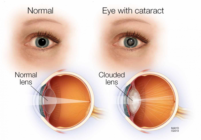 Understanding Working Lenses, Cataract Types, Diagnosis, and Eye Care