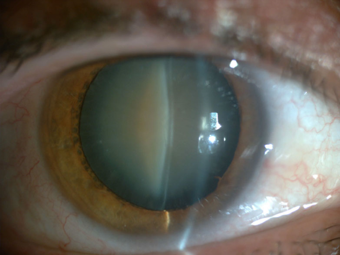 Understanding Working Lenses, Cataract Types, Diagnosis, and Eye Care