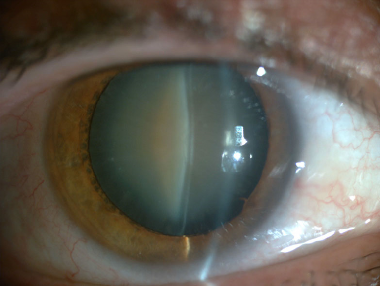 Understanding Working Lenses, Cataract Types, Diagnosis, and Eye Care