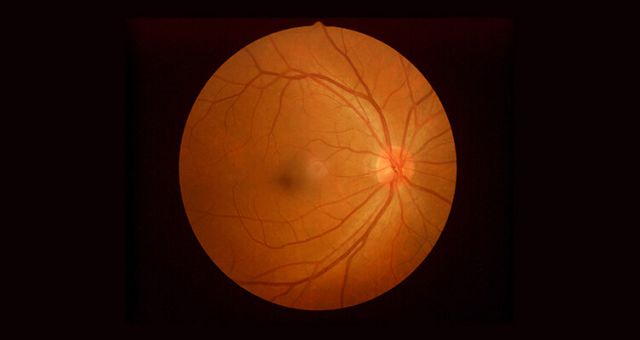 Everything you need to know about Retinal break and its treatment