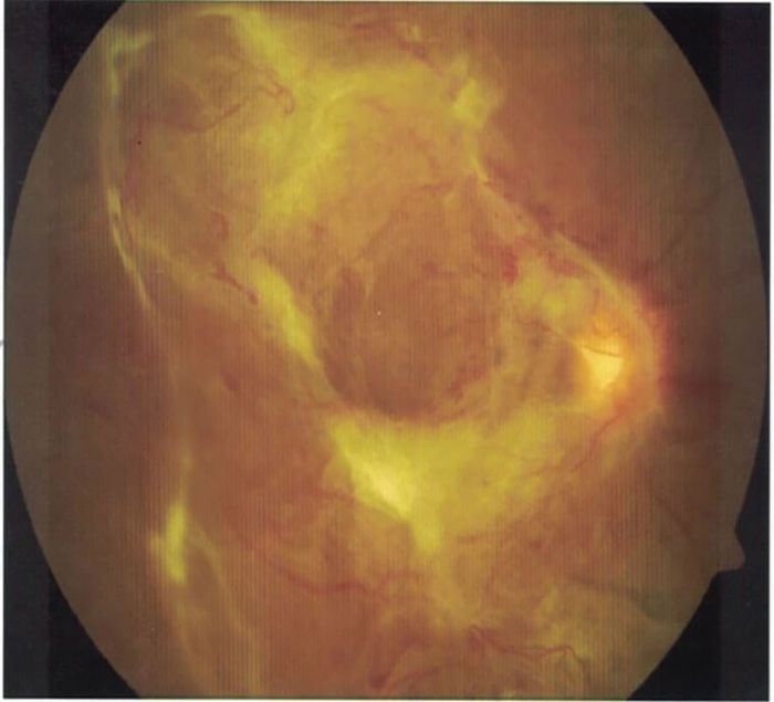 Detached Retina, Types, Symptoms, Causes, Treatment | Neoretina