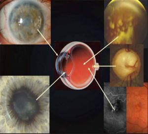 Symptoms and Treatment for Uveitis