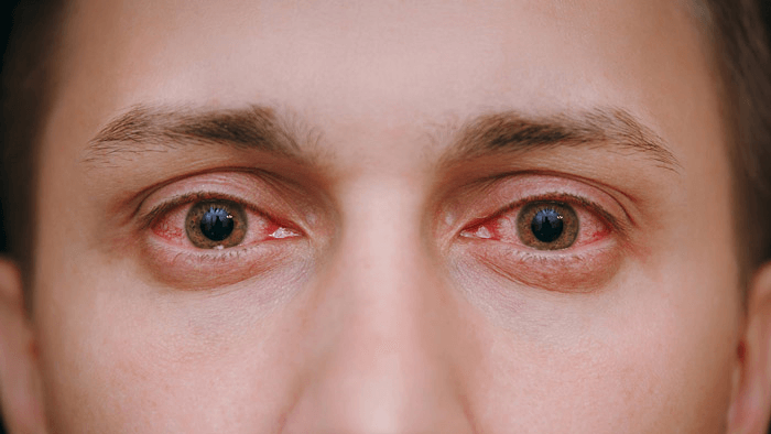 Indications of Eye Problems, Signs, Symptoms | Neoretina