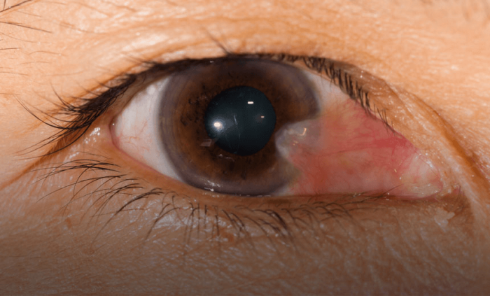 Indications of Eye Problems, Signs, Symptoms | Neoretina