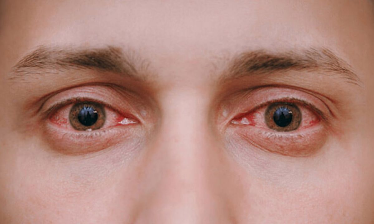 Yellow Eyes Causes And Treatment Infoupdate Yellow Eyes Causes And Treatment Infoupdate