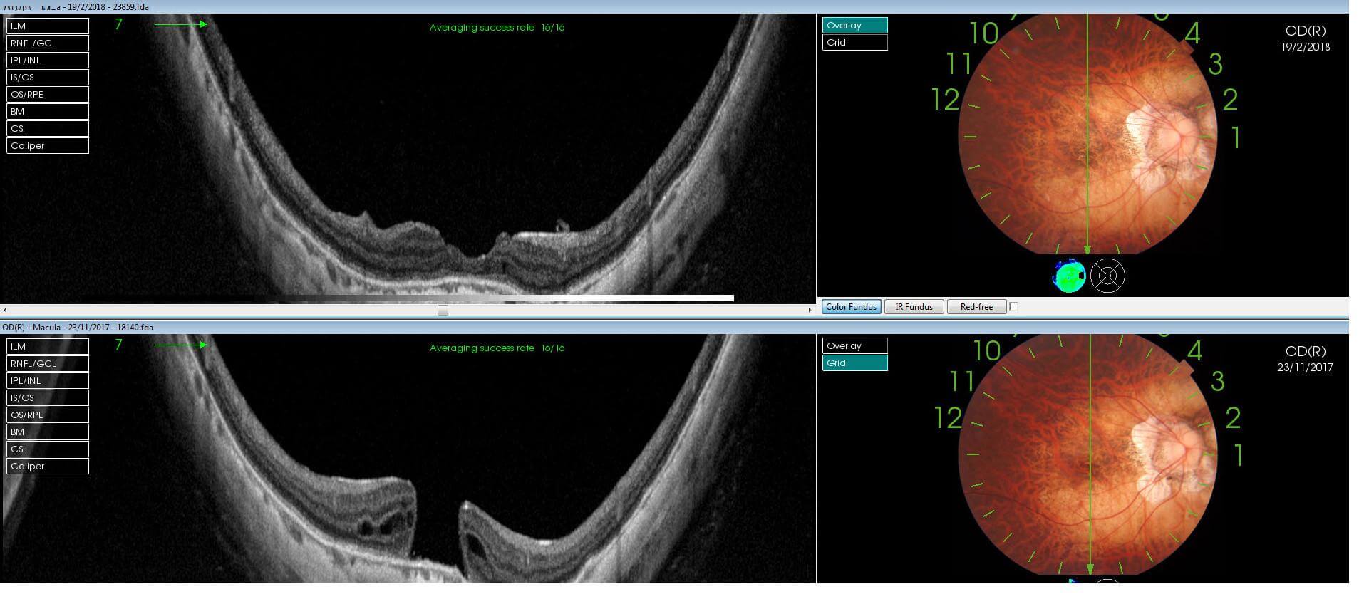 Understand the symptoms, causes, treatment of a Macular Hole