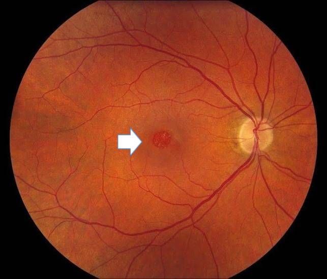 Understand the symptoms, causes, treatment of a Macular Hole