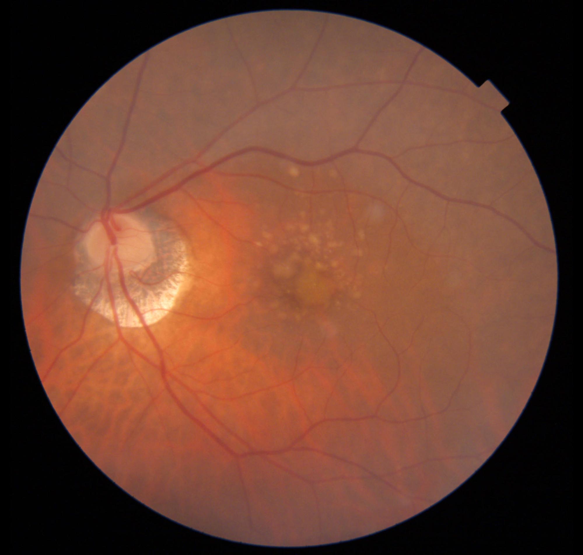 Things you should know about Age-related Macular Degeneration