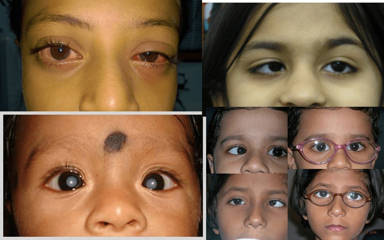 Symptoms that show your child needs a paediatric ophthalmologist