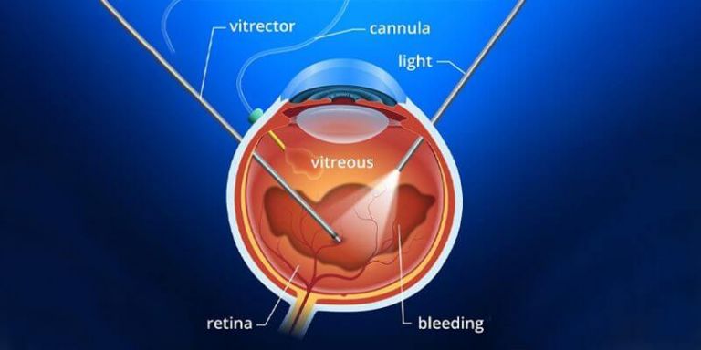 Vitrectomy Surgery: Risks and postoperative care |Neoretina