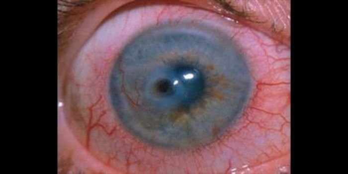 Cornea of Eye: Common Diseases, Symptoms & Treatments