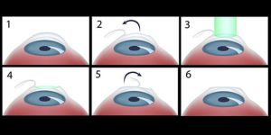 A Complete Guide to LASIK Surgery | Neoretina