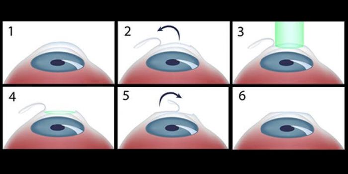 A Complete Guide to LASIK Surgery | Neoretina