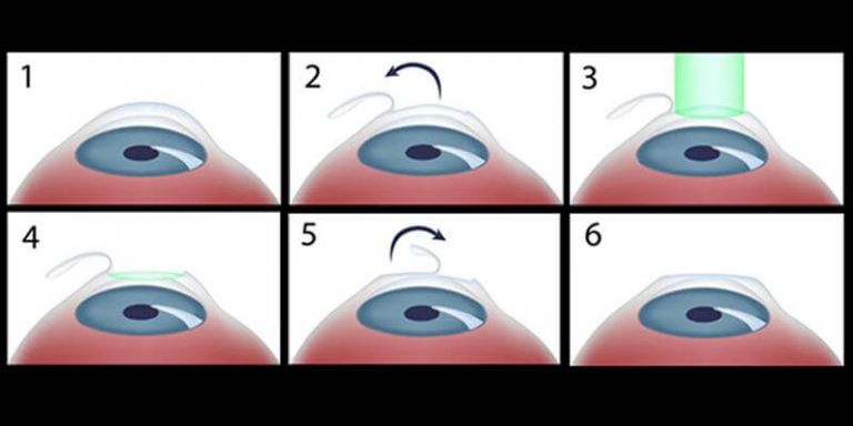 A Complete Guide to LASIK Surgery | Neoretina