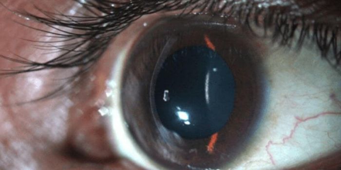 Keratoconus: Diagnosis, Screening, and Treatment | Neoretina