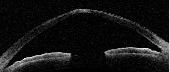 Keratoconus: Diagnosis, Screening, and Treatment | Neoretina
