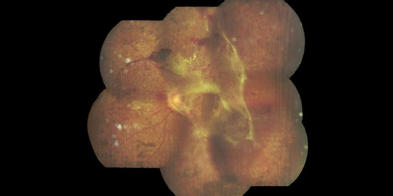 Diabetic Vitrectomy Everything You Need to Know About the Procedure