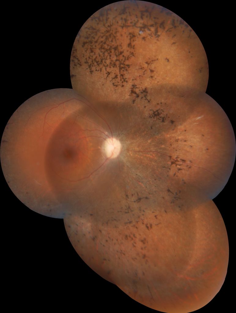 Understanding Retinitis Pigmentosa - Causes, Symptoms, Treatment