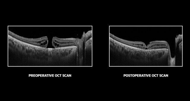Macular Holes and Surgery: Treatment and Aftercare