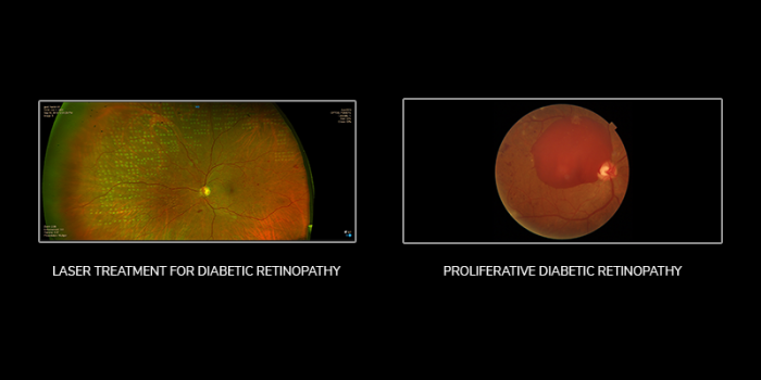 Diabetic Retinopathy: Symptoms, Causes, Stages & Treatment Options