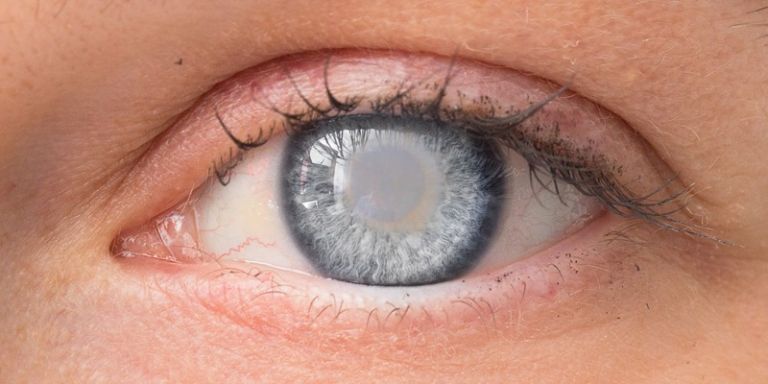 Cortical cataracts symptoms, causes and treatment - Neoretina Blog