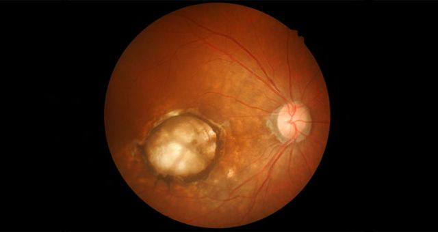 Introduction to Common Retinal Disorders, Symptoms, Causes | Neoretina