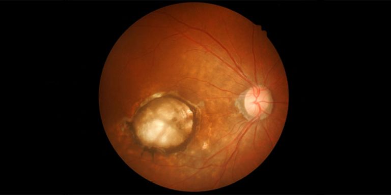 Everything you need to know about Retinal break and its treatment