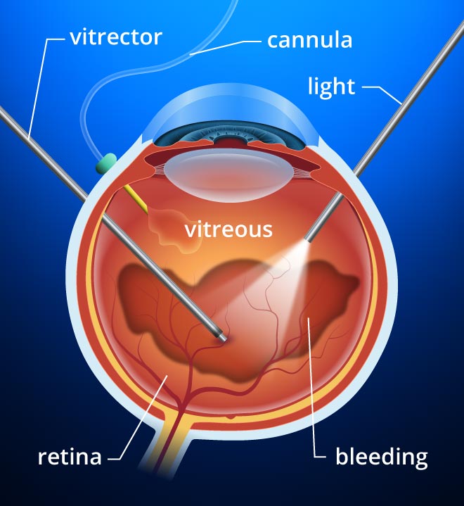 Combined surgery: Understanding cataract and vitrectomy surgery