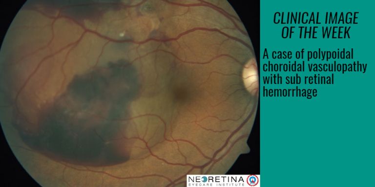 A case of polypoidal choroidal vasculopathy with sub retinal hemorrhage - Neoretina Blog