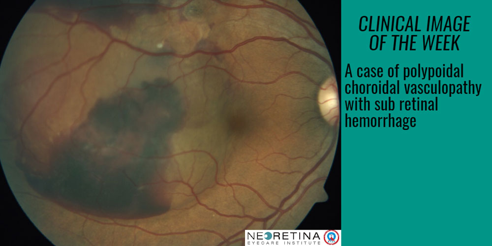 A case of polypoidal choroidal vasculopathy with sub retinal hemorrhage - Neoretina Blog