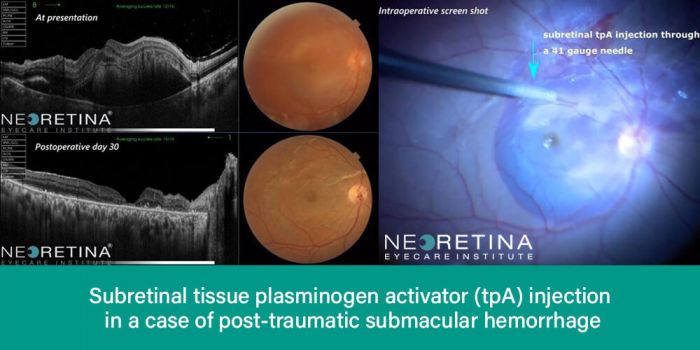 Subretinal tissue plasminogen activator (tpA) injection in a case of ...