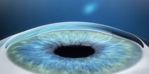 A Complete Guide to Types of LASIK Surgery | Neoretina