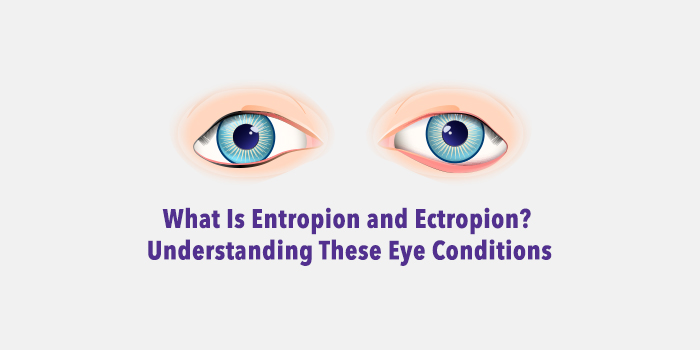Entropion and Ectropion Eye Issues - Symptoms Causes and Effective Care