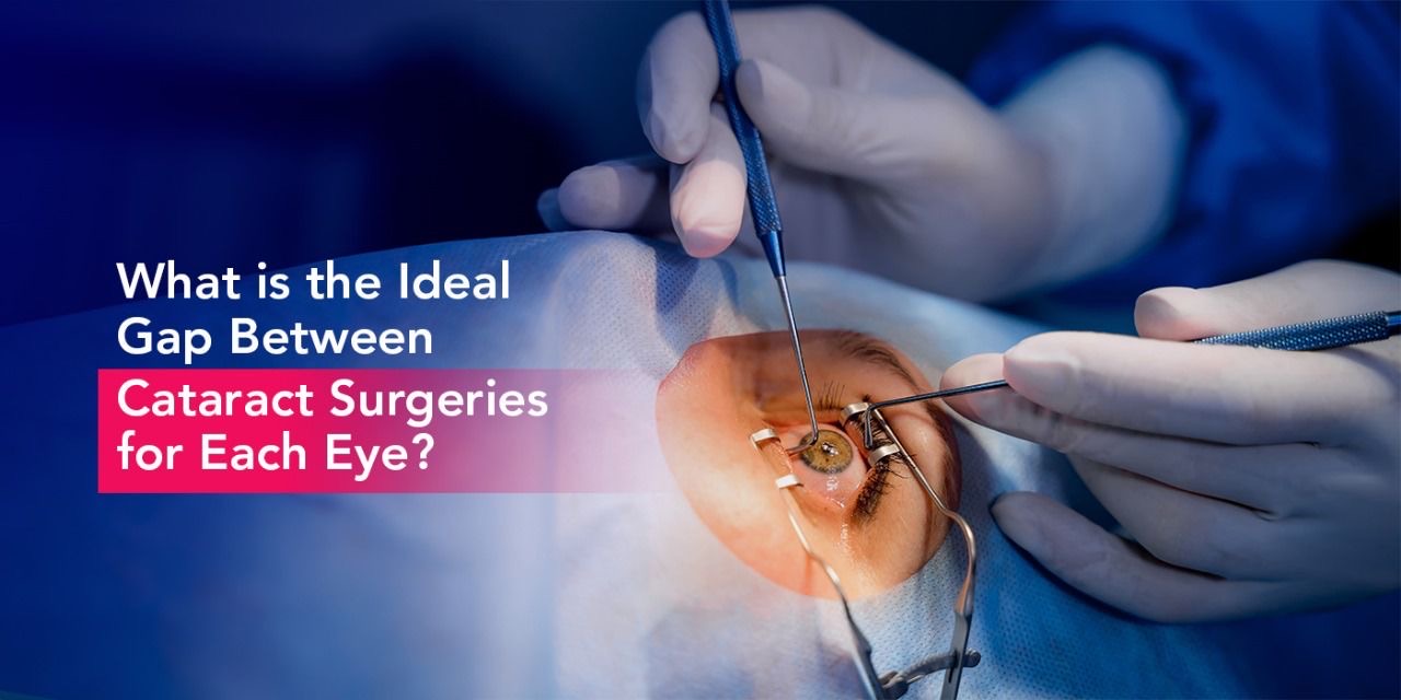 Know the Ideal Gap Between Cataract Surgeries for Each Eye