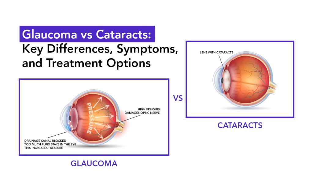 Glaucoma vs Cataracts: Key Symptoms, Causes & Treatments