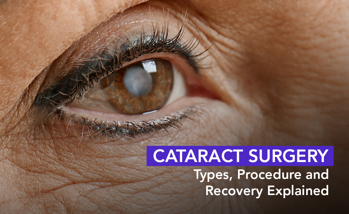 Cataract Surgery: Types, Procedure & Recovery Guide